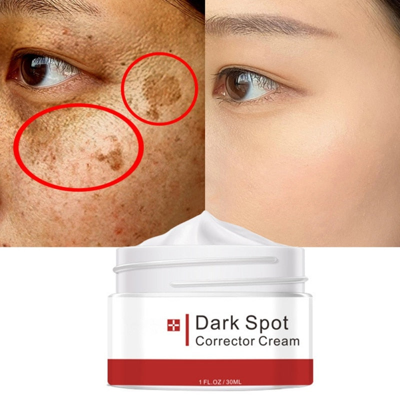 Brown Spots Freckles Repair Damaged Skin Black Spot Correction Creams ...